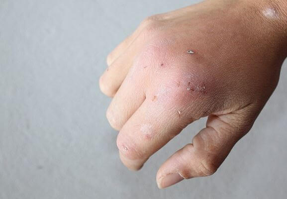 Maladie des griffes du chat – INOVIE +me